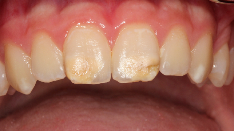 Molar Incisor Hypomineralisation - Everything You Need to Know — Nova ...