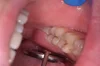 Operculectomy Treatment For Wisdom Teeth - Everything you need to know ...