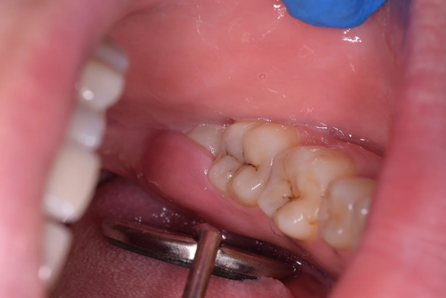 Operculectomy Treatment For Wisdom Teeth - Everything you need to know ...