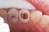 What It Means When Your Dentist Says You Have Had A Deep Filling — Nova ...