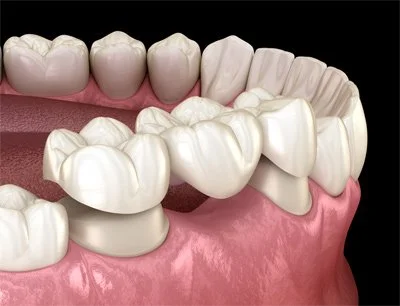 Dental Bridges: Comprehensive Guide to Types, Costs, and Care — Nova Smiles