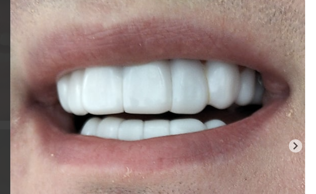 Complete expert guide to clip-on veneers — Nova Smiles