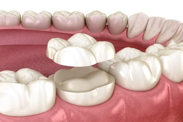 Why teeth with root canal fillings need crowns (or preferably onlays ...