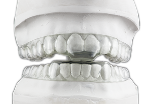 B Splints - Everything you need to know — Nova Smiles