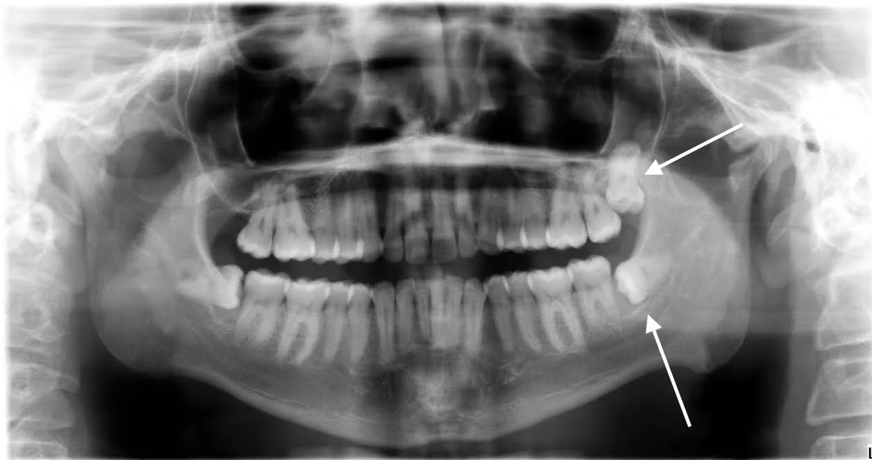 Impacted wisdom teeth - Everything you need to know — Nova Smiles