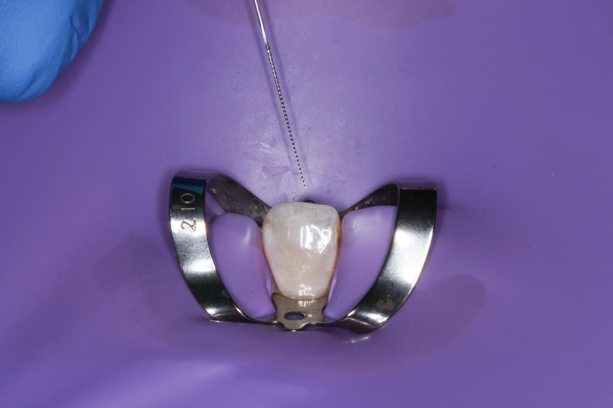 Pulp Extirpation Explained: Pain Relief and Root Canal First Step ...