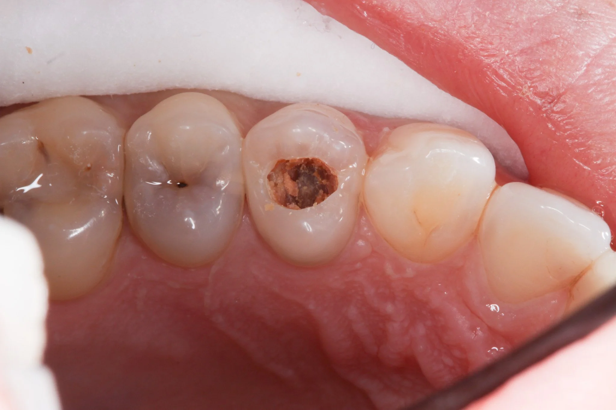 Broken Filling: Do You Need to Replace It? — Nova Smiles