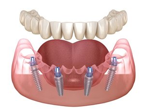 Dental Implant Types - A comprehensive guide — Nova Smiles