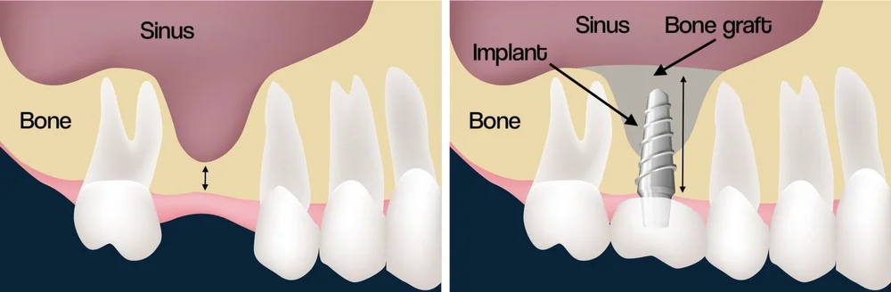Understanding Sinus Lift Procedures: A Comprehensive Guide for Dental ...