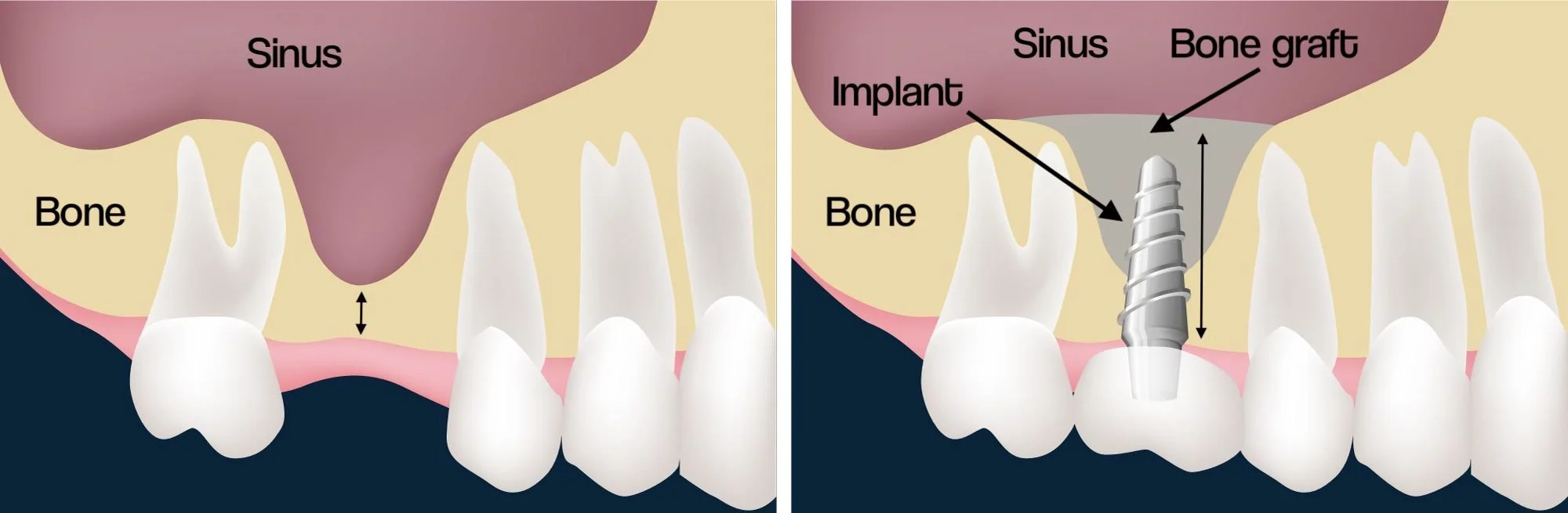Understanding Sinus Lift Procedures: A Comprehensive Guide for Dental ...
