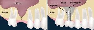 Understanding Sinus Lift Procedures: A Comprehensive Guide for Dental ...