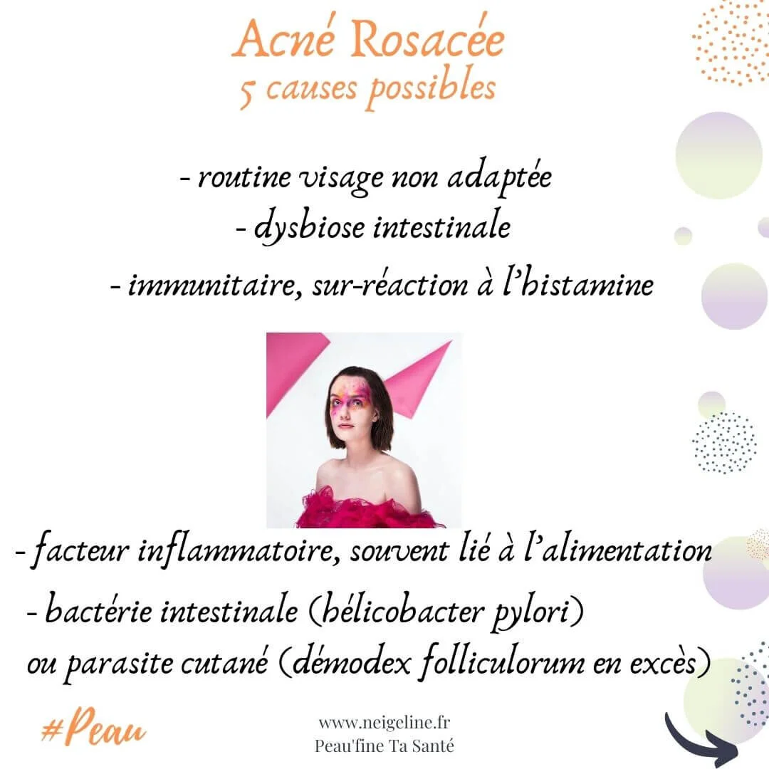 Acné rosacée : 5 façons de s’en débarrasser. — Neigeline, experte Acné