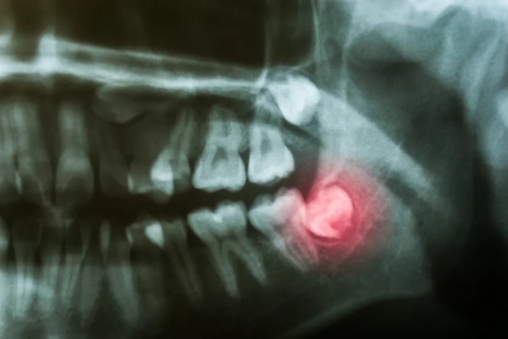 What To Expect With A Tooth Extraction — Woodsprings Dentistry