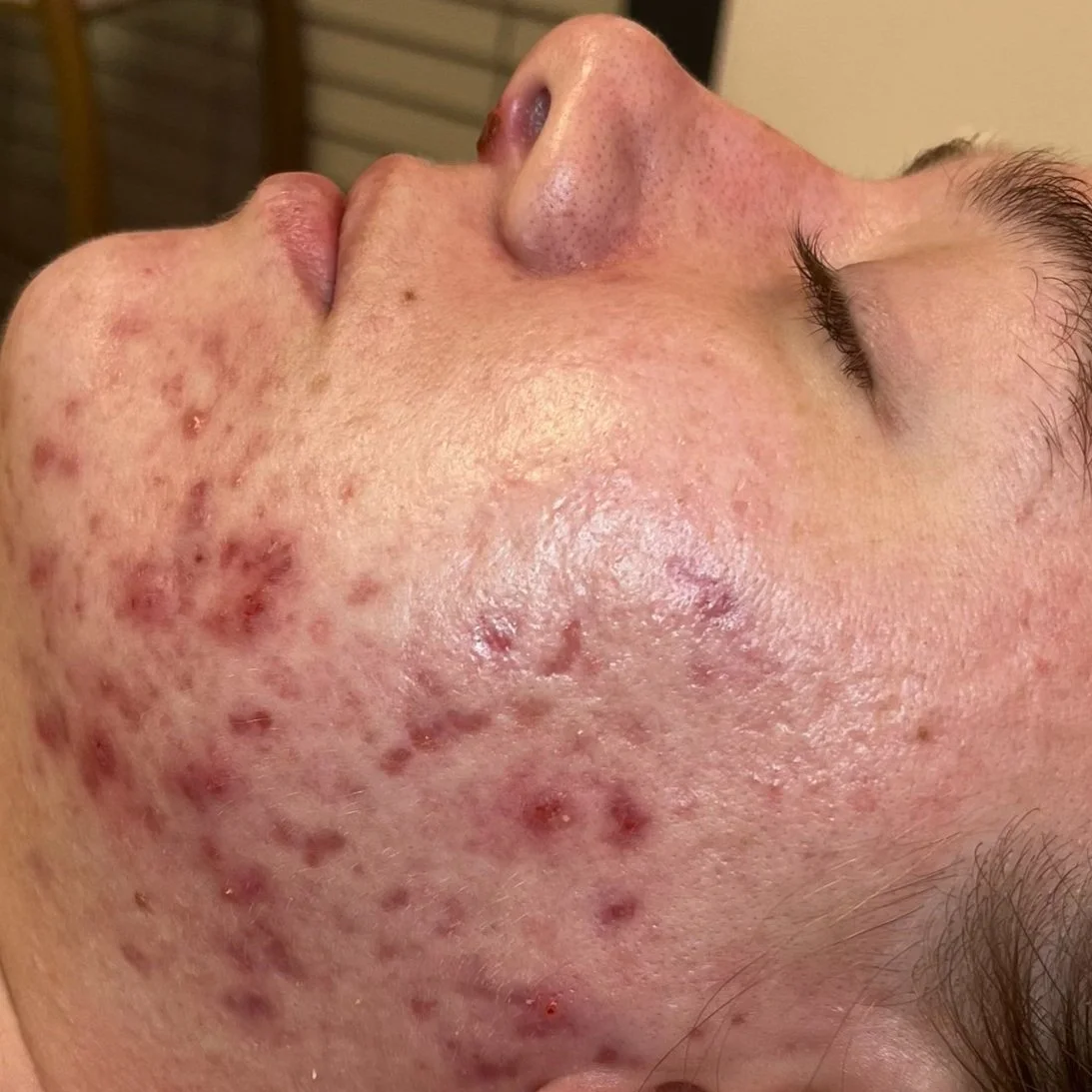 Acne Before/After — JACLYN KYLIE SKINCARE