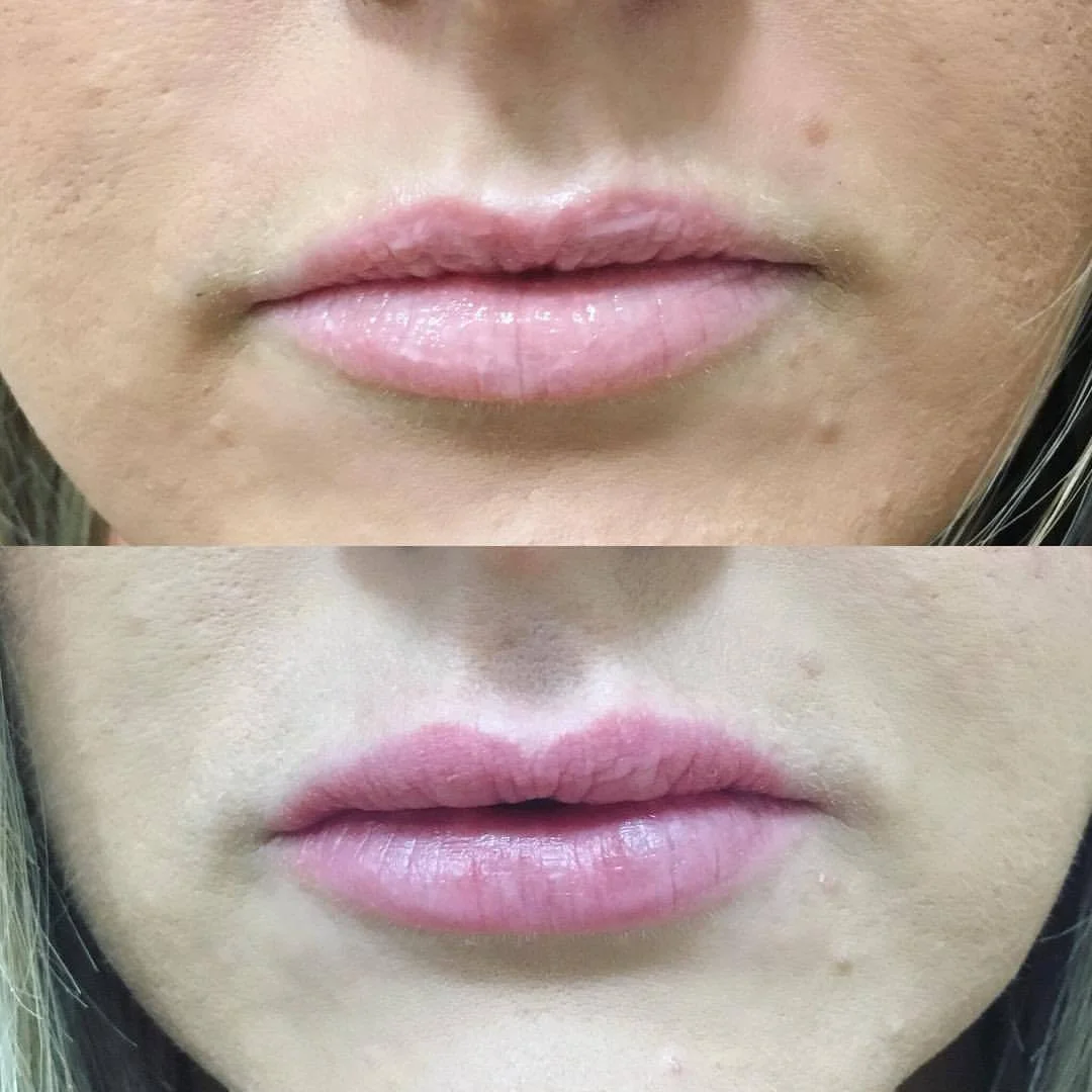 Lip Enhancement — Central Wagga Medical | Cosmetic Treatments and ...