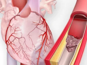 Cardiac Arrest — Heart Safe Australia