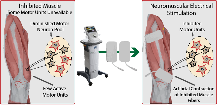 Neuromuscular Electrical Stimulation (NMES) — LIVE4 Sports Physical Therapy & Wellness Advising