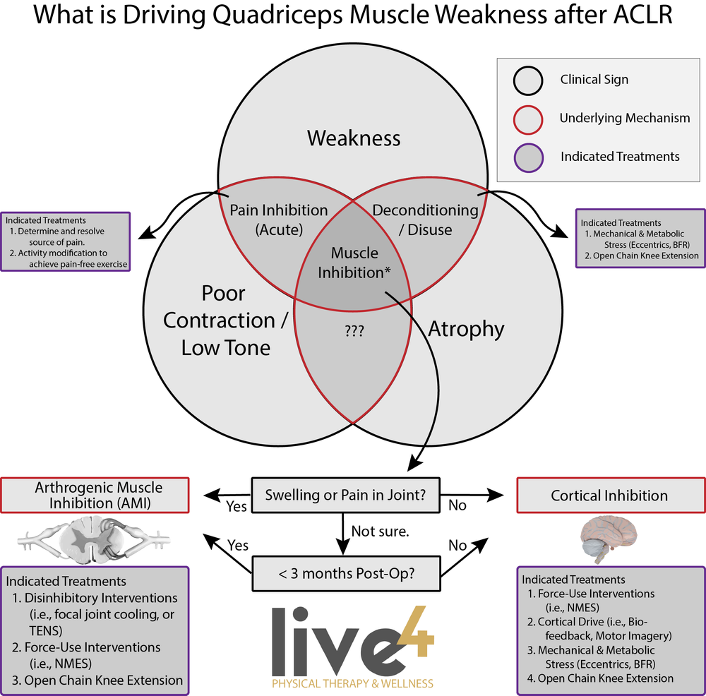 Selecting ACL Rehabilitation Treatments — LIVE4 Sports Physical Therapy ...