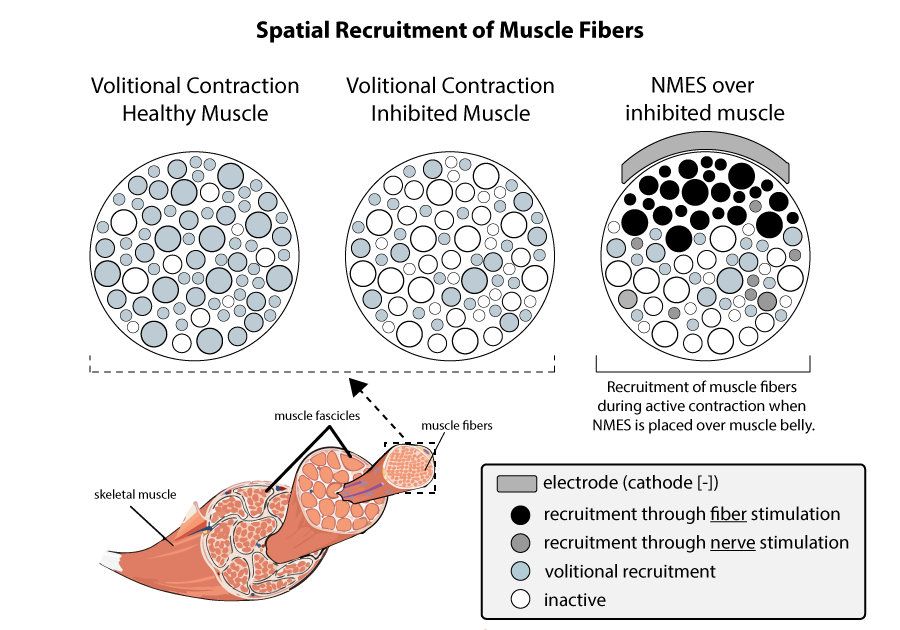 Neuromuscular Electrical Stimulation (NMES) — LIVE4 Sports Physical ...