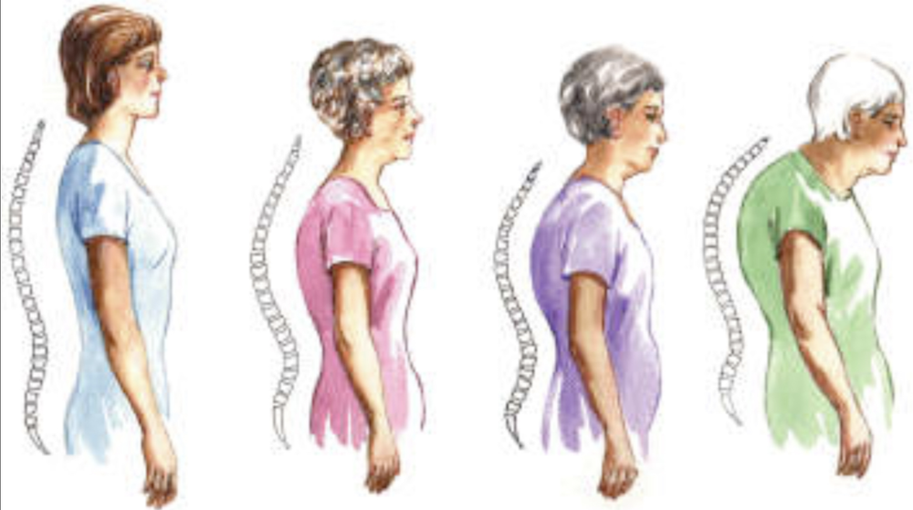 Hunchback shoulders. How to avoid this rounded shoulder posture ...