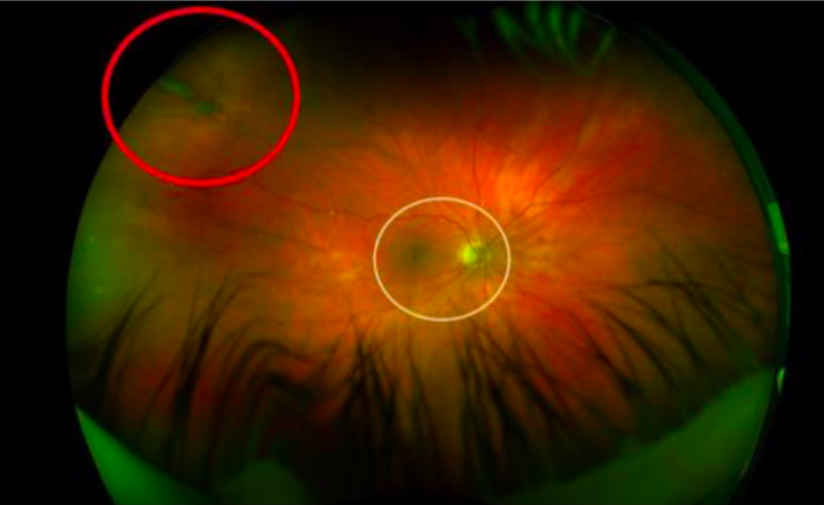 Retinal Detachment Floaters
