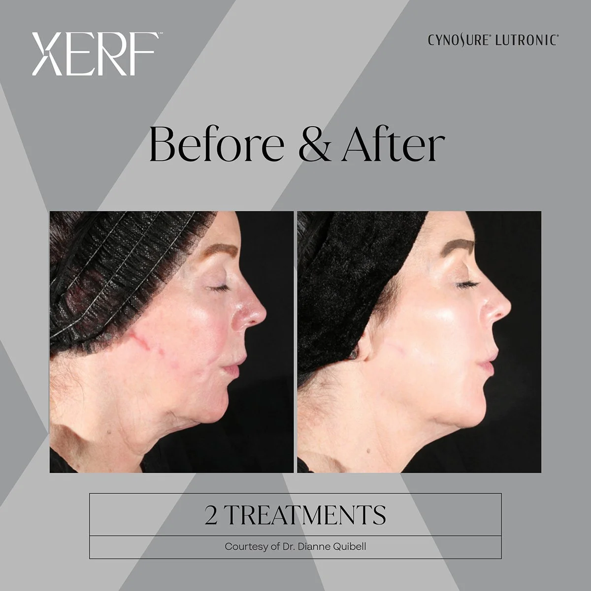 Structural Skin Tightening with XERF: A New Era in Non-Invasive Lifting ...