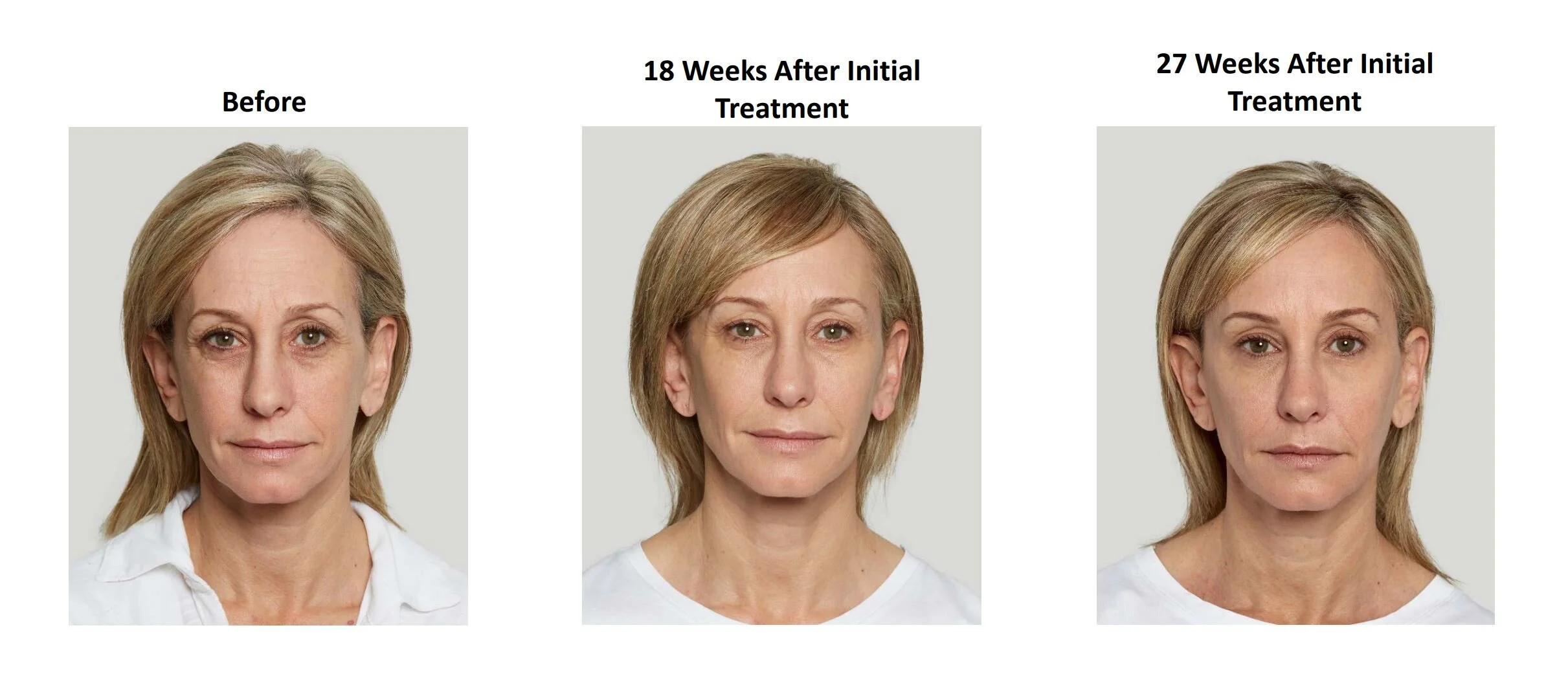 ultherapy — EMSELLA — Rejuve Medspa — Rejuve Medspa