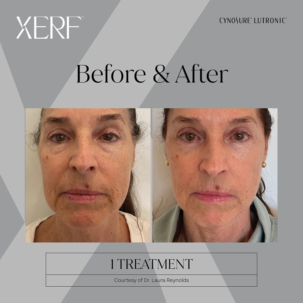 Structural Skin Tightening with XERF: A New Era in Non-Invasive Lifting ...