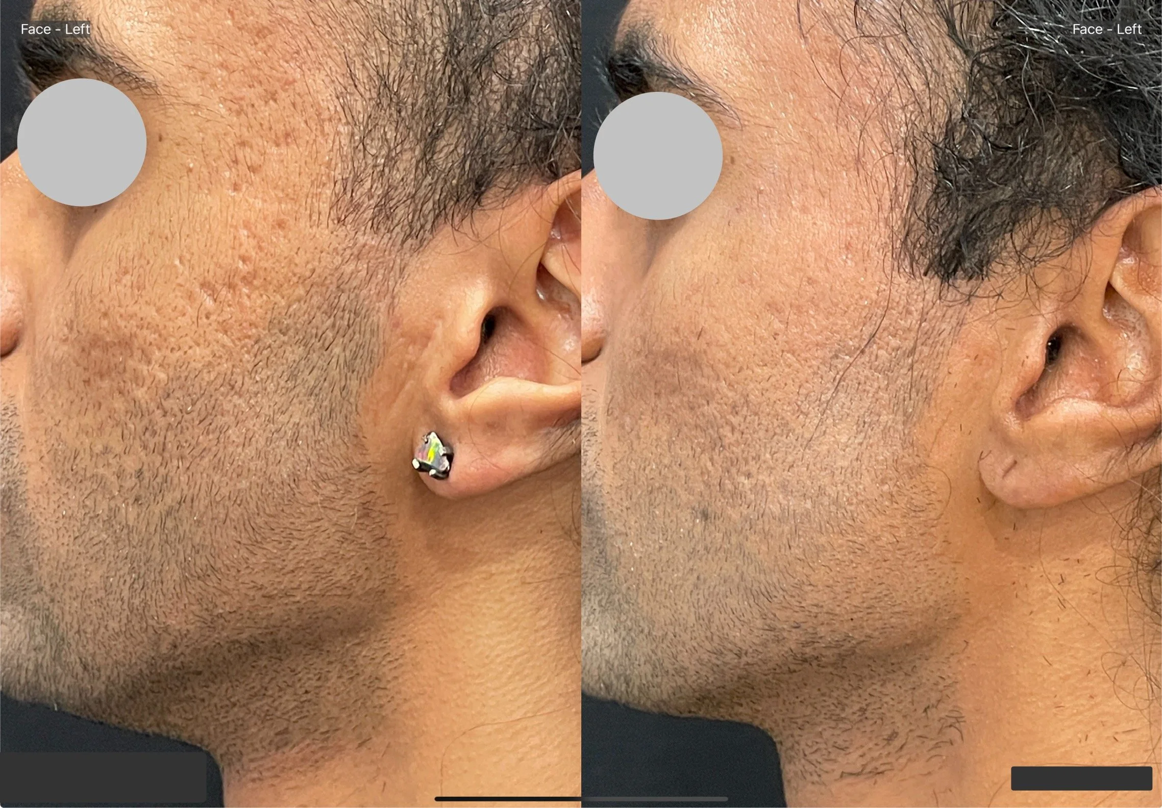 Acne Treatment | Acne Scar Revision — Rejuve Medspa | Newcastle near ...