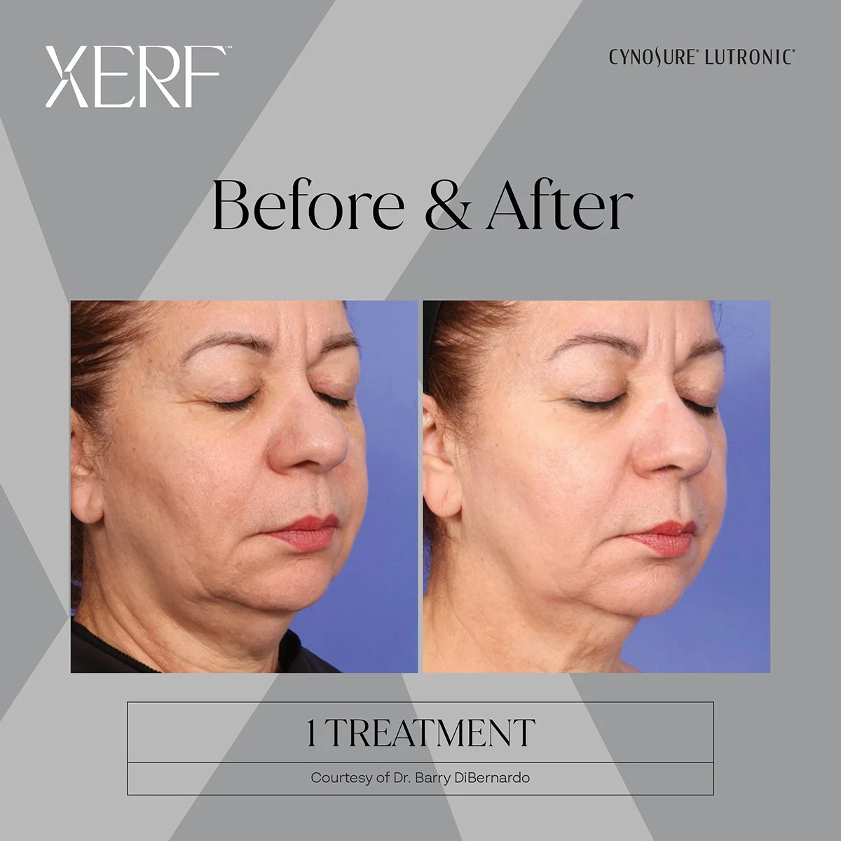 Structural Skin Tightening with XERF: A New Era in Non-Invasive Lifting ...