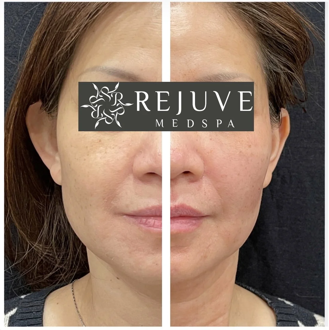 Genius RF Microneedling - Why Its so Effective for Skin Tightening and ...