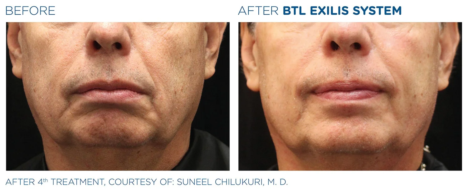 Non-Surgical Eye Lift - Exilis Ultra 360 — Rejuve Medspa | Newcastle ...