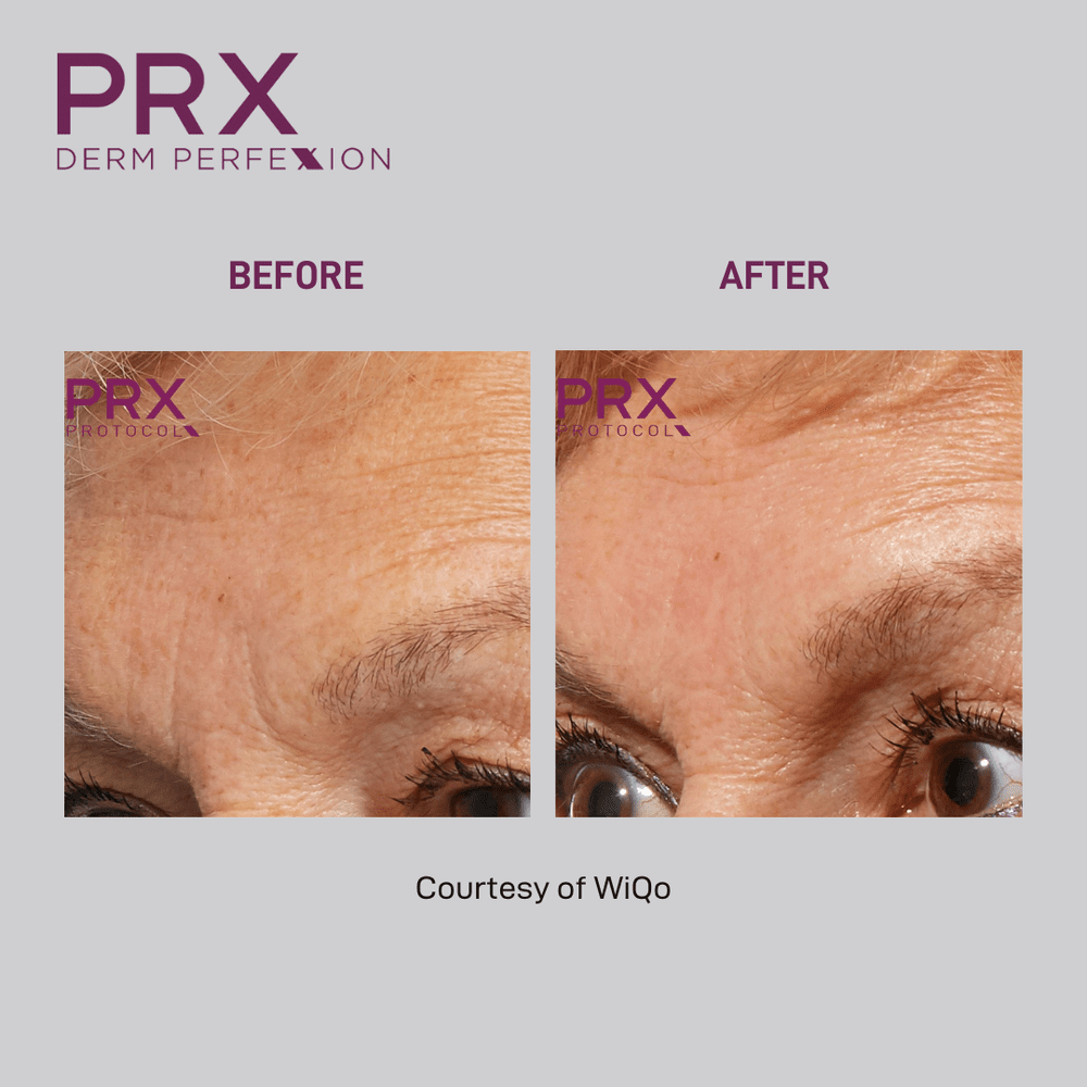 PRX Chemical Peel — Rejuve Medspa | Newcastle near Seattle, Bellevue ...
