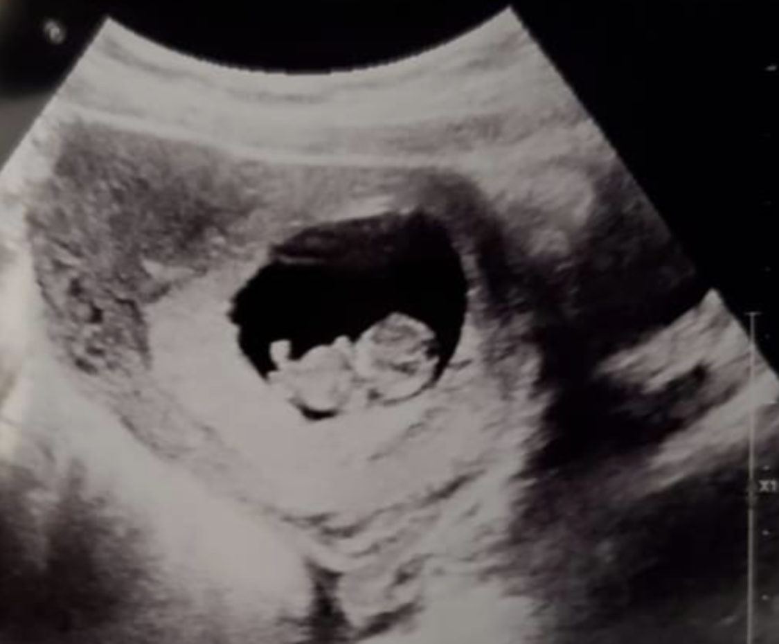 Early Pregnancy Scans | Baby Scans from 8 Weeks | Meet the Baby