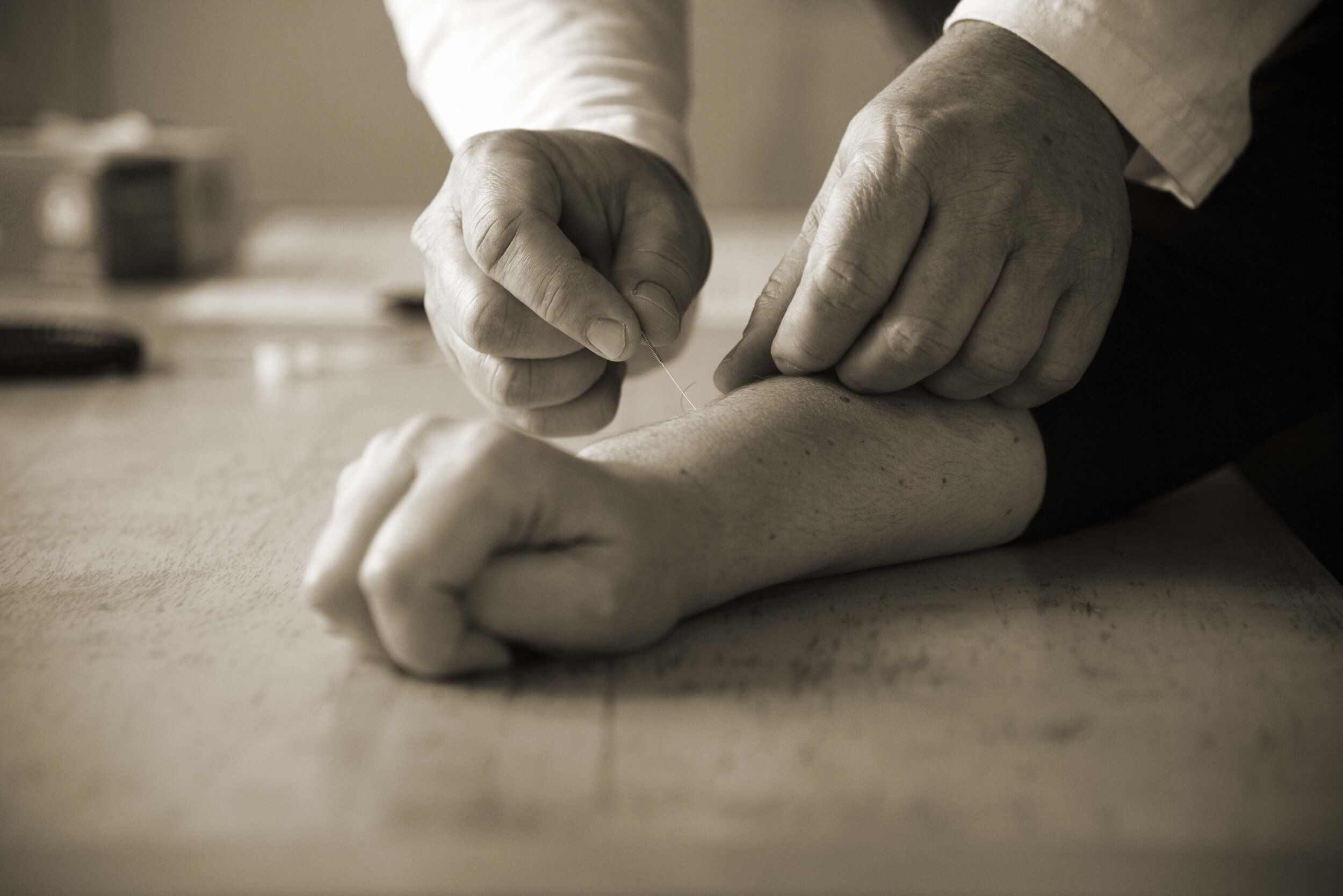 Acupuncture treatments — Church Street Practice | Osteopathy Bradford ...