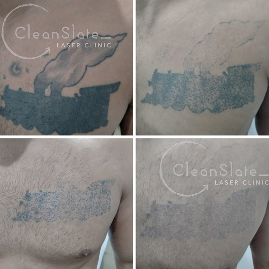 Tattoo Removal Gallery - Canggu Bali | Cleanslate Laser Clinic