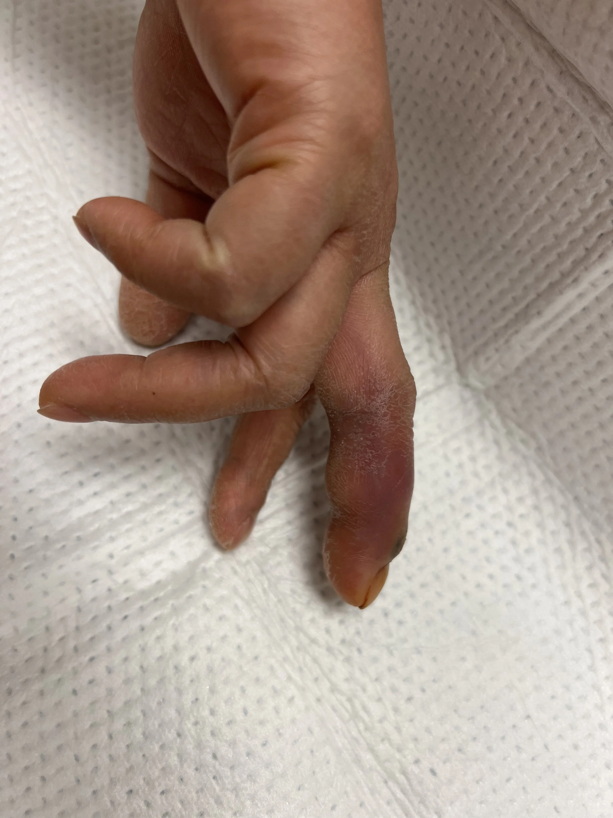 Code Paronychia! — The Proceduralist