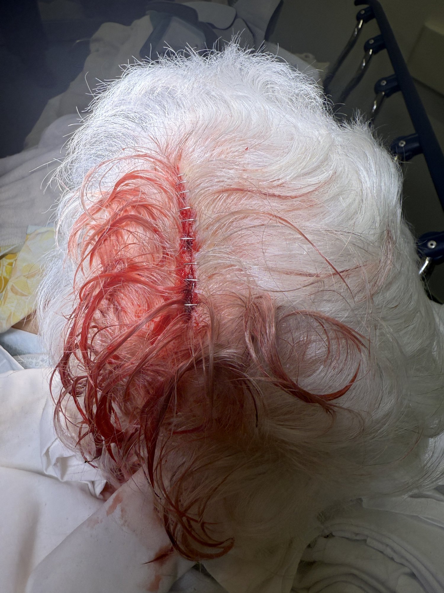 Scalp Laceration in Elderly Patient with Staple Closure — The Proceduralist