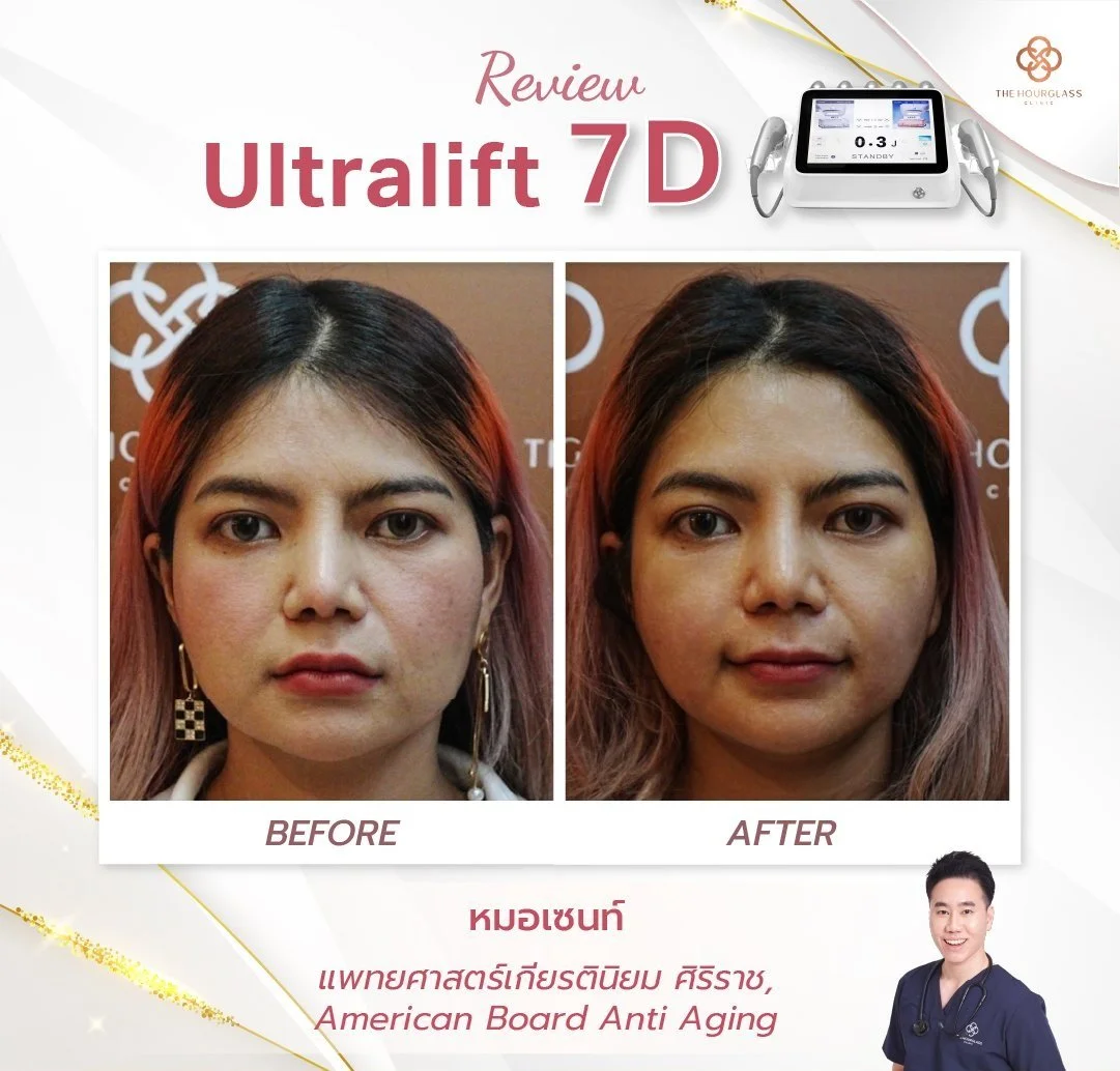 รีวิว ยกกระชับ ปรับรูปหน้า ด้วย Ultraformer III, Ultralift HIFU | The Hourglass