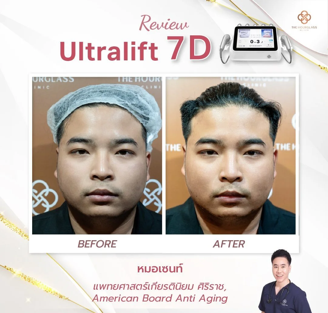 รีวิว ยกกระชับ ปรับรูปหน้า ด้วย Ultraformer III, Ultralift HIFU | The Hourglass