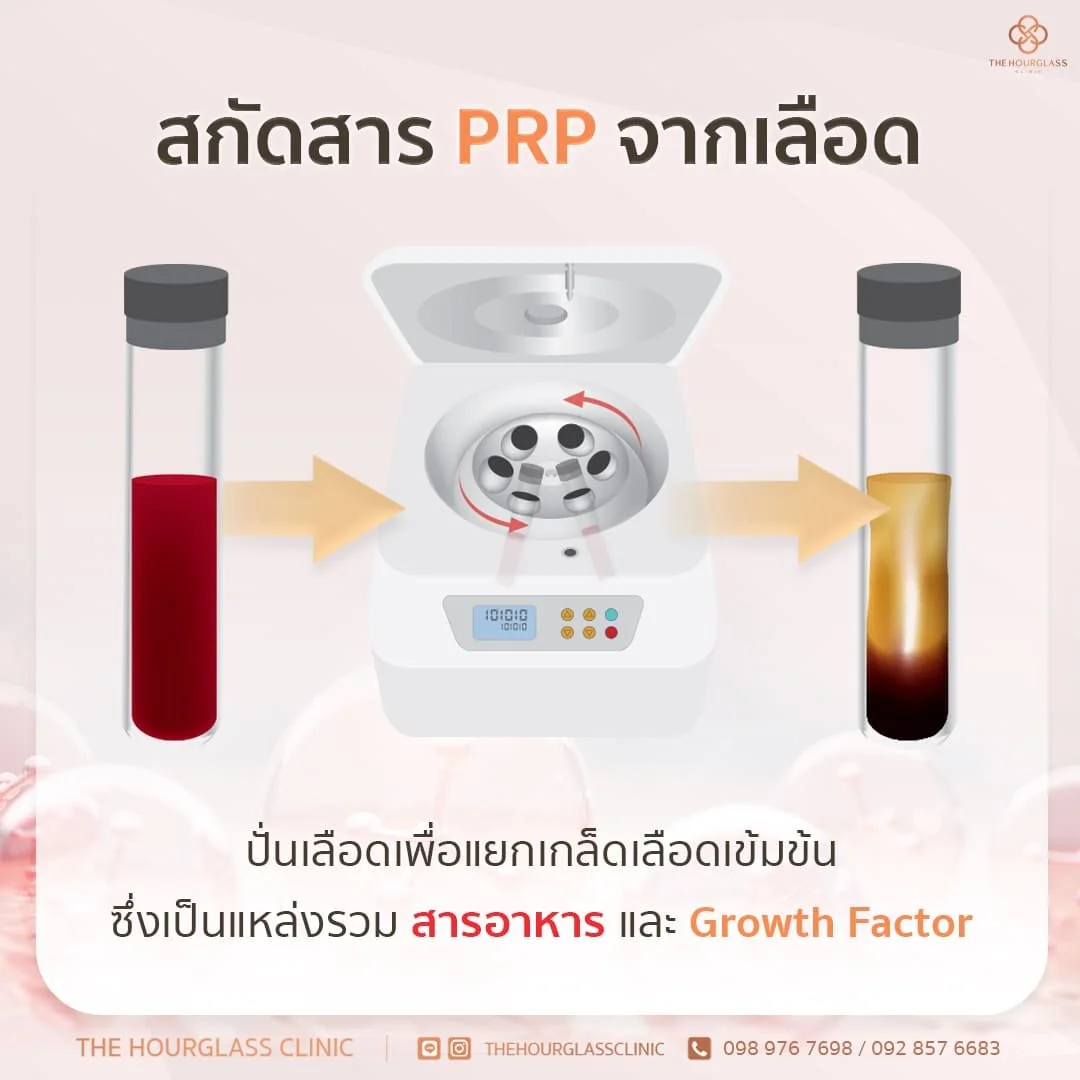 PRP (Platelet Rich Plasma) | ฟื้นฟูผิวหน้า ลดริ้วรอย กระตุ้นคอลลาเจน ...