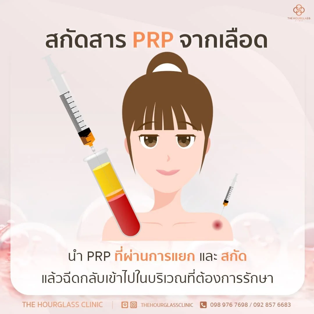 PRP (Platelet Rich Plasma) | ฟื้นฟูผิวหน้า ลดริ้วรอย กระตุ้นคอลลาเจน ...