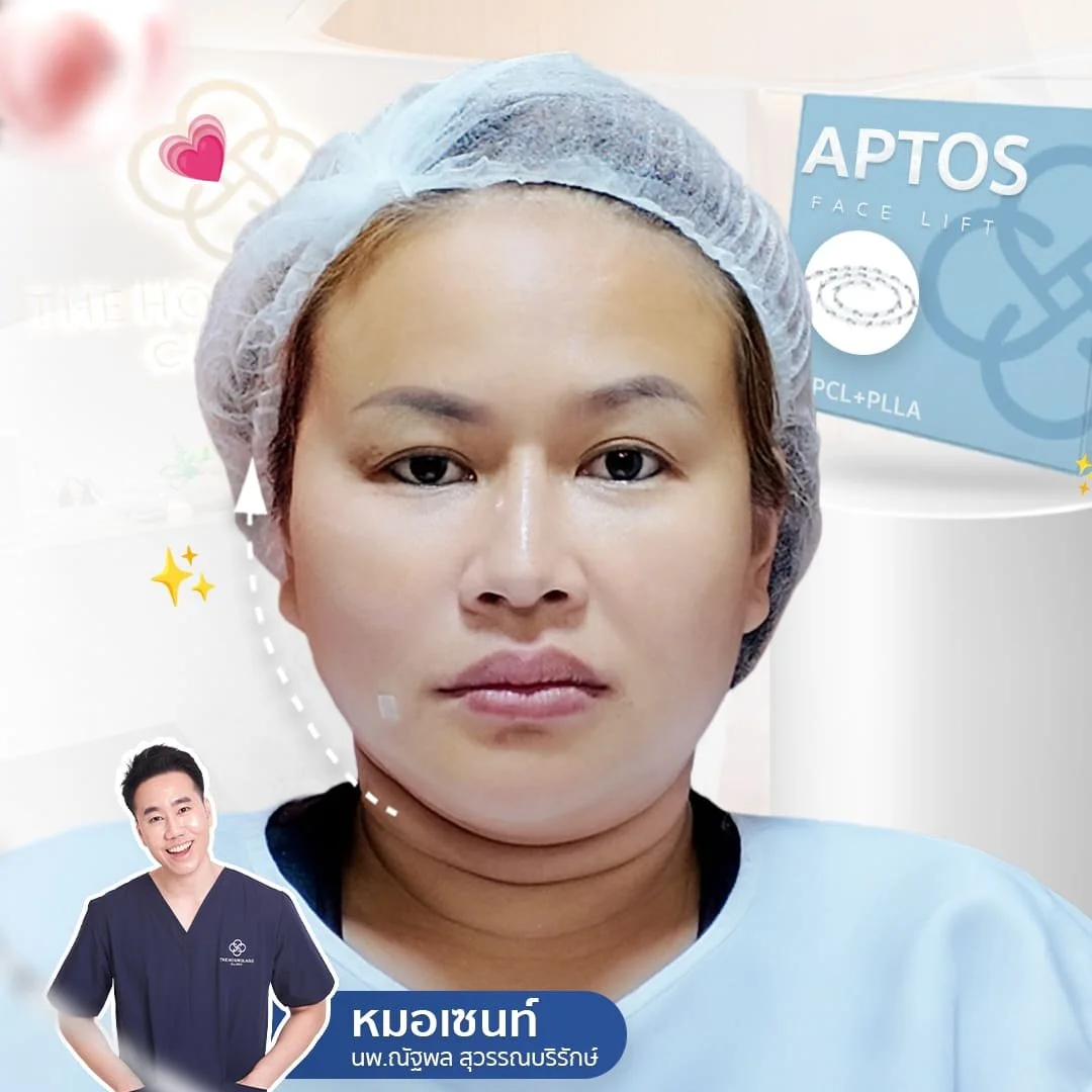 ร้อยไหม APTOS คืออะไร? ยกกระชับหน้า ผิวใส แบบ ไม่ต้องผ่าตัด | The Hourglass
