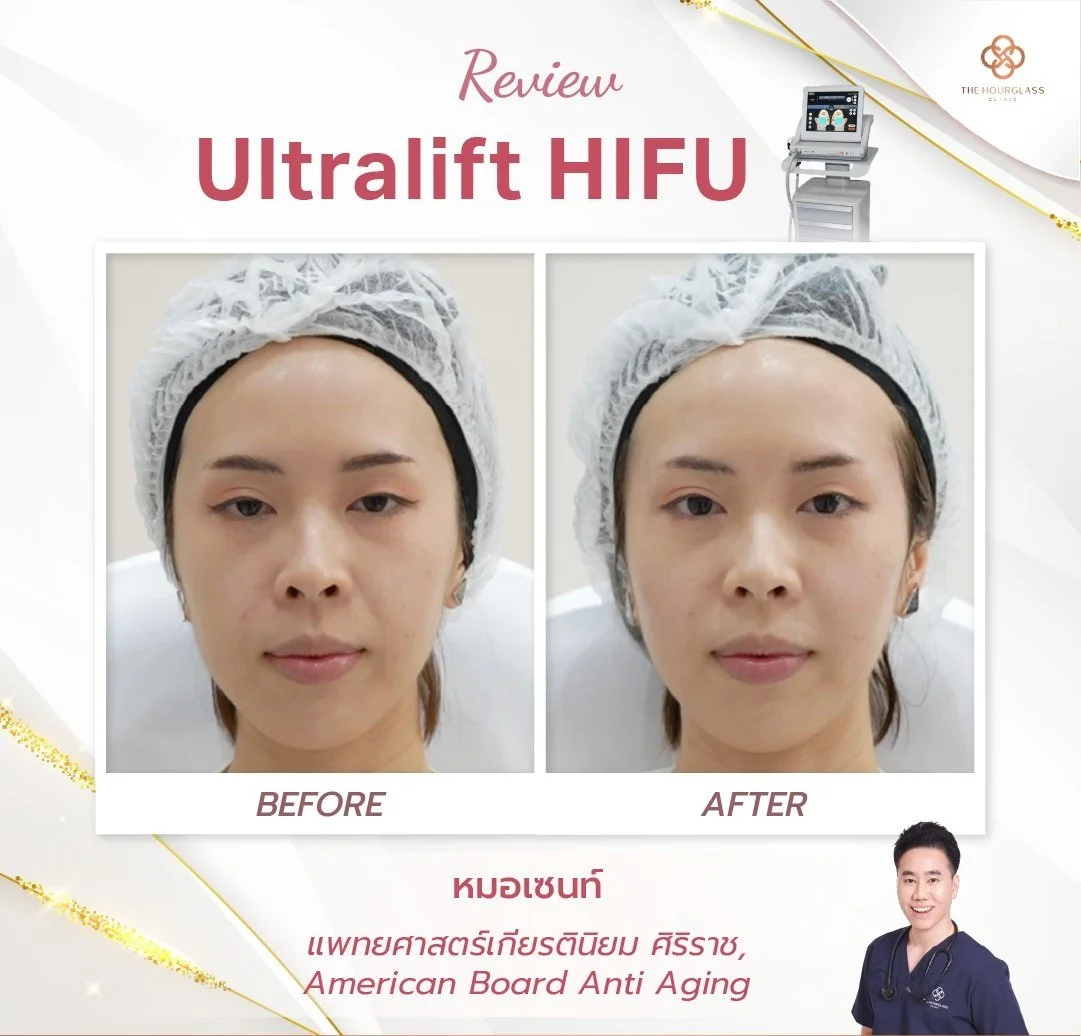 ยกกระชับหน้า ปรับรูป หน้าเรียว - หน้าวีเชฟ ย่านบางนา ด้วย Ultraformer III และ Ultralift HIFU ...