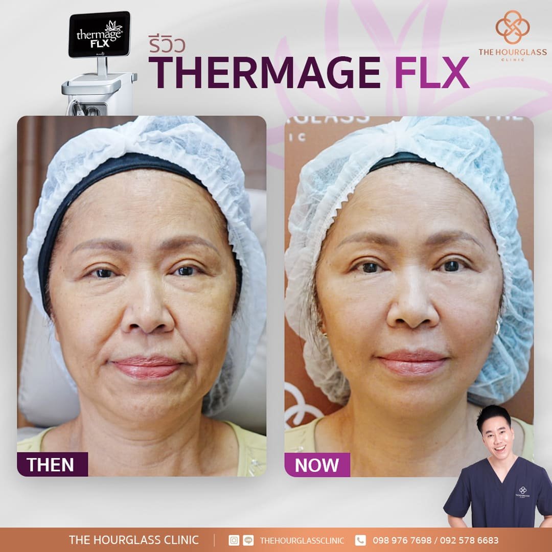 Thermage FLX คืออะไร ⎜Thermage รีวิว ⎜The Hourglass Clinic | The Hourglass