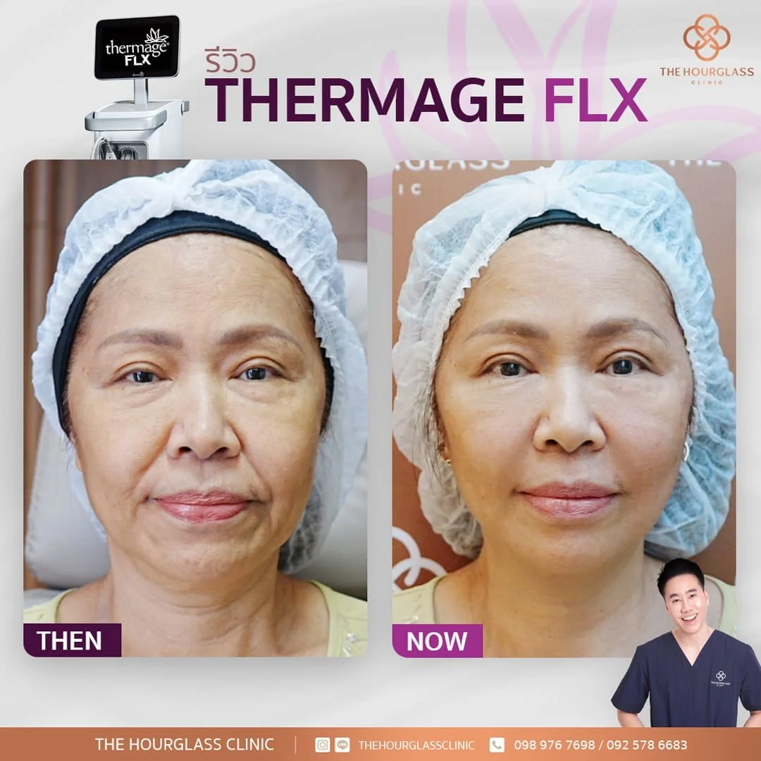 Thermage FLX คืออะไร ⎜Thermage รีวิว ⎜The Hourglass Clinic | The Hourglass