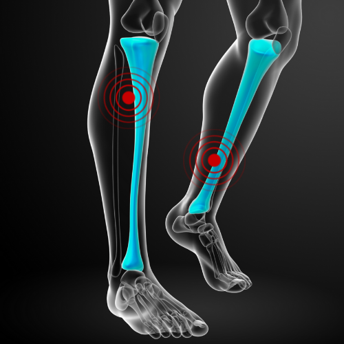 What to do about shin splints: — Ascend Physical Therapy