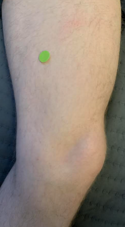 The Top Five (and One Secret) Acupuncture Points for Diabetes — St ...