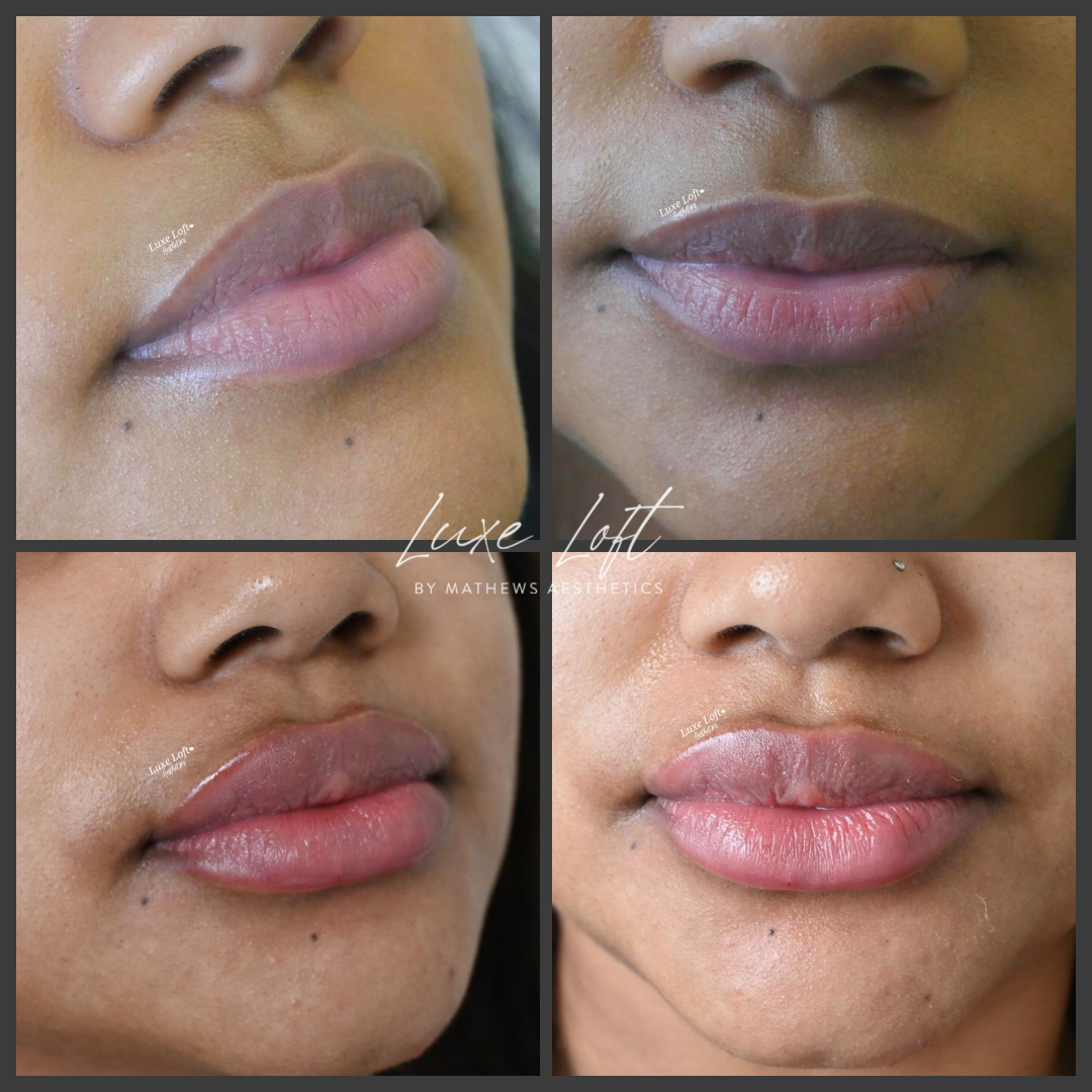 LIP FILLER GALLERY | See Stunning Transformations — Luxe Loft