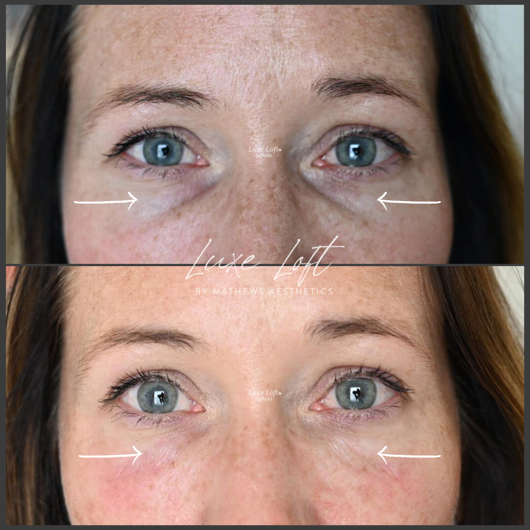 FILLER GALLERY | Unleash Your Beauty — Luxe Loft